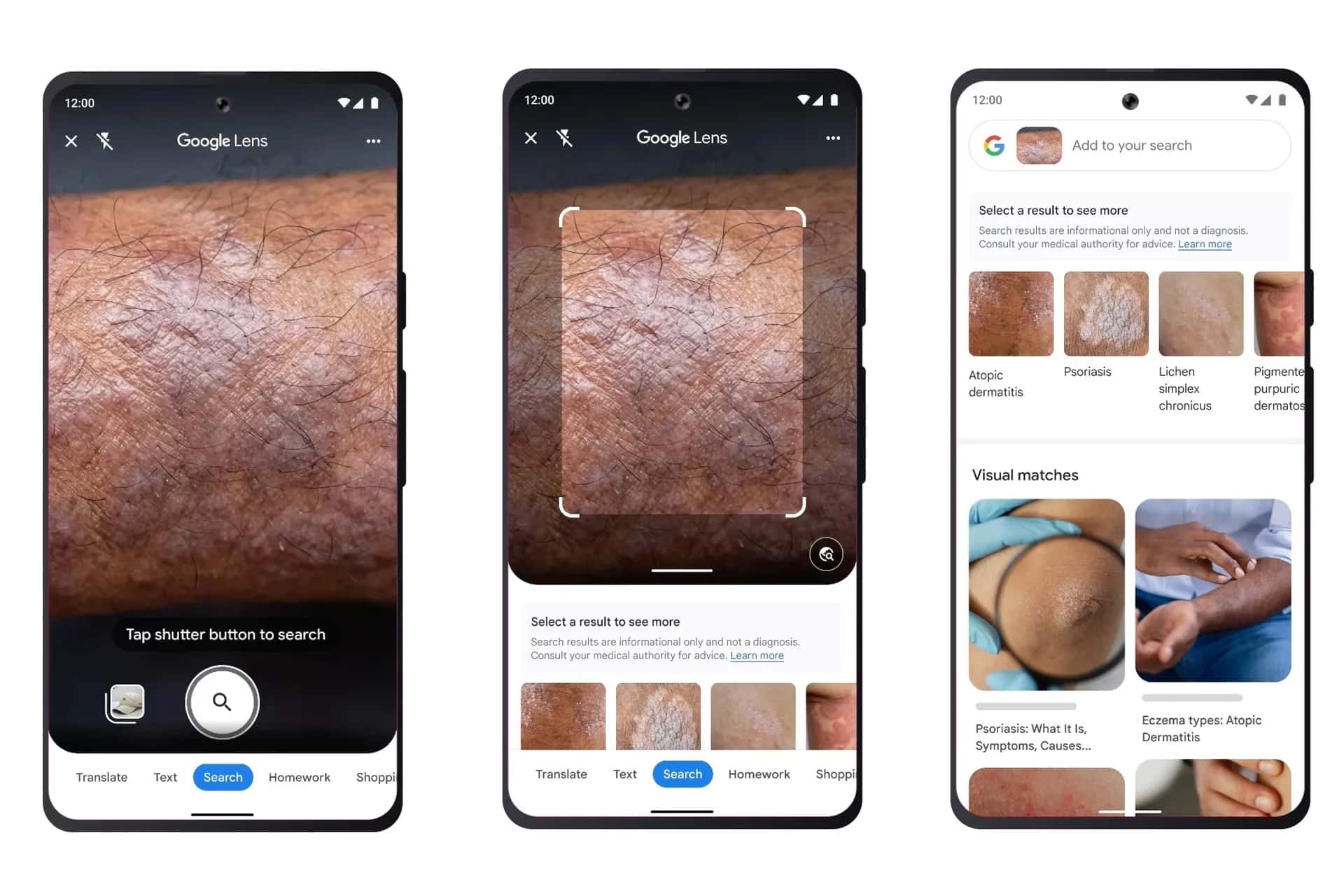 Google Lens devient dermatologue et offre un diagnostic sur vos ...